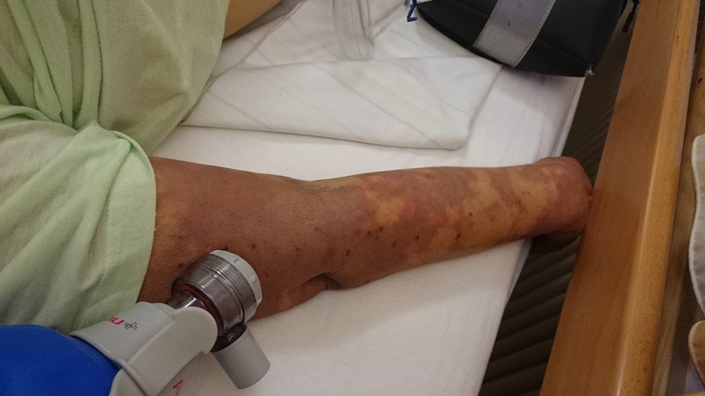 Dialysis Side Effects – 9 Common Effects Kidney Patients Experience ...